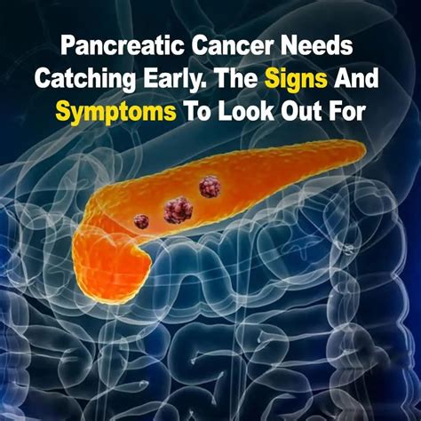 10 Early Signs Of Pancreatic Cancer
