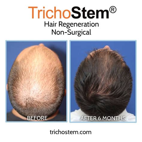Stem Cell Facial What You Need To Know Dr Prasad Blog