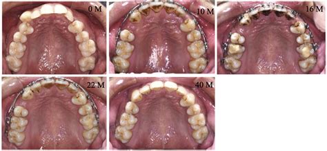 Upper Right Premolar Extraction Arch Developing And Space Closure