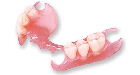 Alternatives To Missing Teeth Flipper Bonded Bridge