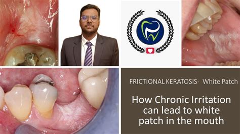 Frictional Keratosis
