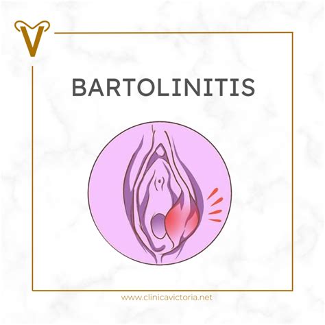 Bartolinitis Clínica Victoria