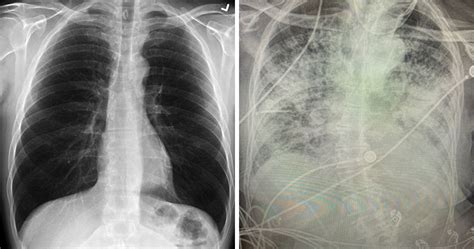 X Ray Shows The Effect Of COVID On The Lungs Compared To A Smokers Lungs Bored Panda