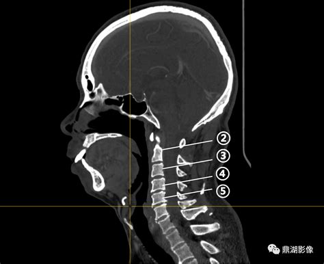 学了这么多年的颈动脉分叉定位竟然是错的？！ 解剖 颈椎 全网
