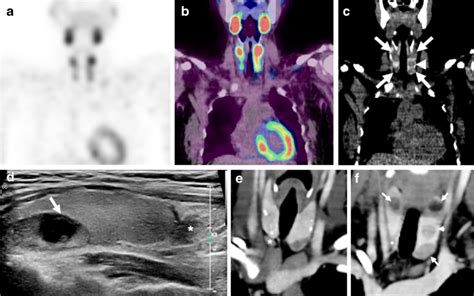 Multi Gland Disease In Tertiary Hyperparathyroidism In A 16 Year Old Download Scientific