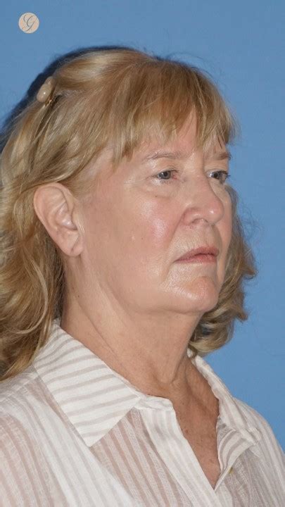 Dr Kevin Sadati On Linkedin Newportbeach Plasticsurgerybeforeandafter Faceliftbeforeandafter