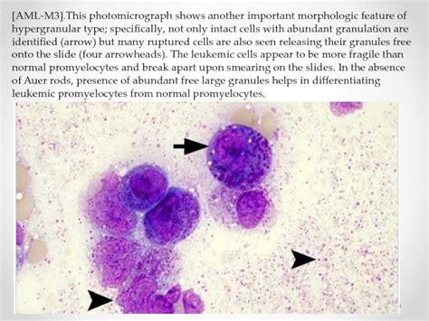 Acute Myeloid Leukemia