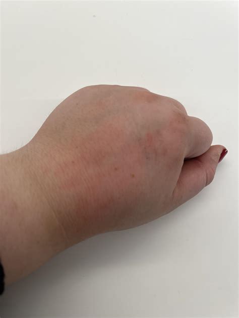 Milk Makeup Allergic Reaction Rmakeupaddiction