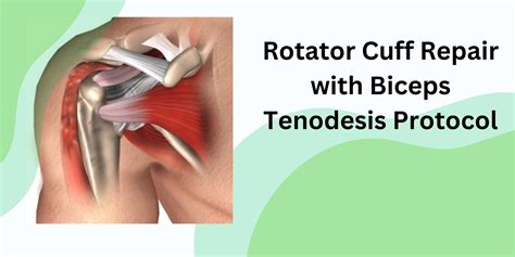 Rotator Cuff Repair With Biceps Tenodesis Protocol Clinicspots