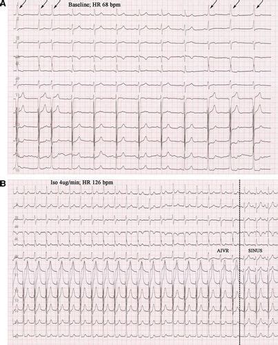 Idiopathic Accelerated Idioventricular Rhythm Or Ventricular