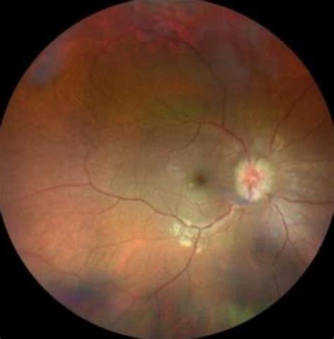 Bilateral Papilledema Case Report Ophthalmology Cases Hypotheses