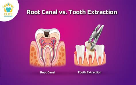 Root Canal Vs Tooth Extraction Elite Dental Care