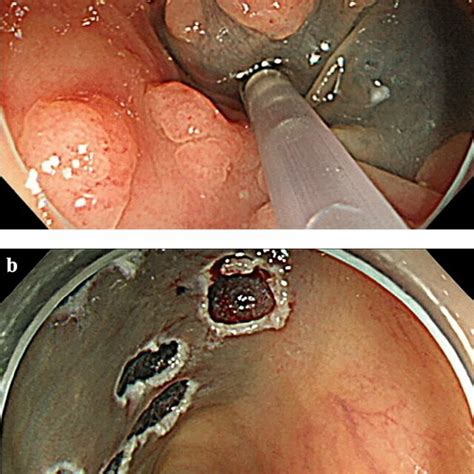 Colonoscopic Polypectomy Of Multiple Polyps A Endoscopic Mucosal Download Scientific Diagram