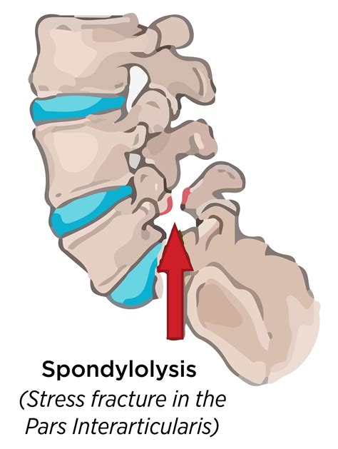 What Is Bilateral Pars Defect At L5 Mapasgmaes