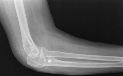 Technique Spotlight Parallel Plating Of Olecranon Fractures Clinical Tree
