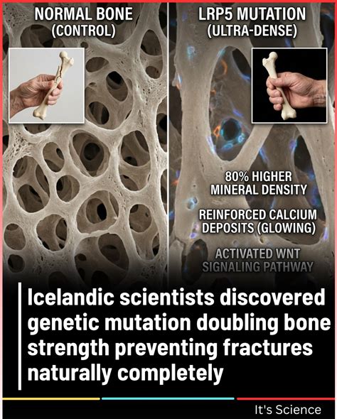 Its Icelandic Scientists Discovered Genetic Mutation Doubling Bone