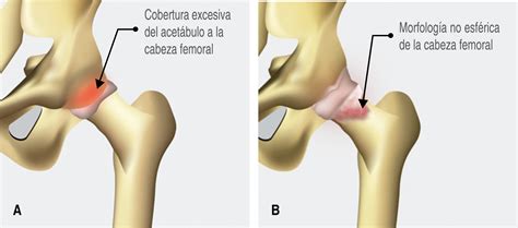 Anatomía De La Cabeza Femoral Síndrome De Pinzamiento