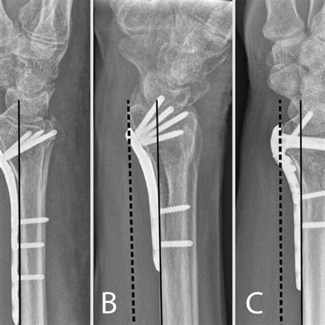 Lateral Radiographs Demonstrating Assessment Using The Soong Download Scientific Diagram