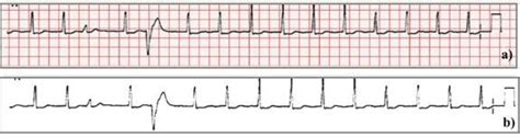 Ecg Signal Before A And After B Processing By Developed Application