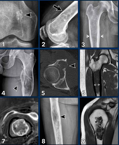 Chondrosarcoma X Ray