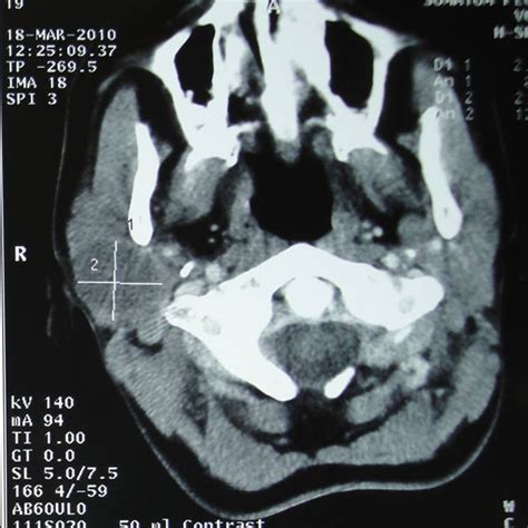 Modified Blair Incision Also Known As A Lazy S Incision Starts In Download Scientific