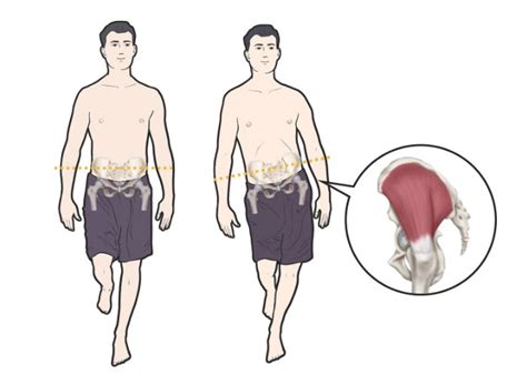 Proximal Hamstring Tear Hip Specialist Los Angeles Orange County Ca