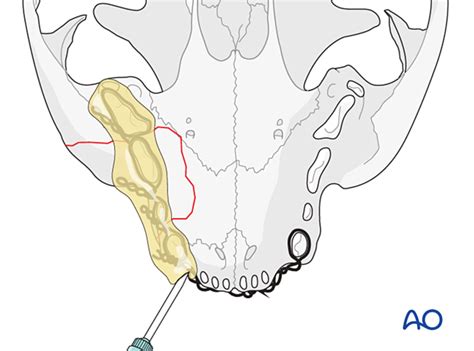 Intraoral Splint Fixation For Midface Caudal Maxillary Fracture