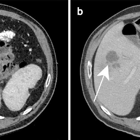 Hiv Related Cholangiopathy In A 16 Year Old Female Patient Coronal