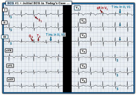 Can You Guess The Diagnosis Dr Smiths Ecg Blog