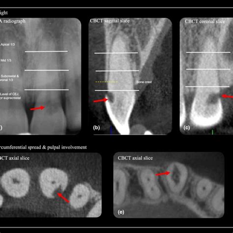 Pdf External Cervical Resorption A Three Dimensional Classification