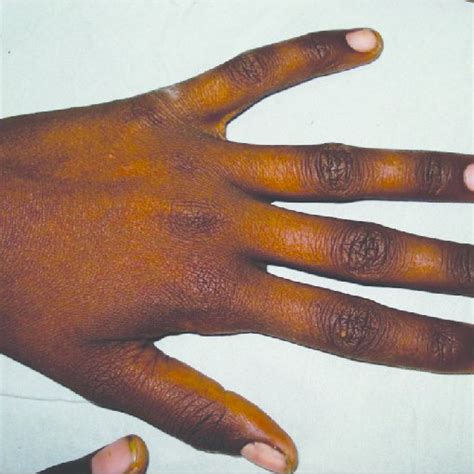 Pdf Phrynoderma In A Patient With Megaloblastic Anemia