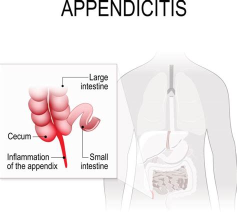Best Appendix Illustrations Royalty Free Vector Graphics And Clip Art