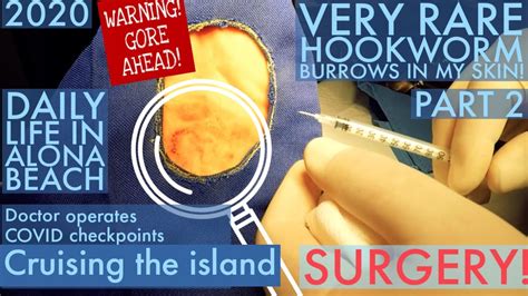 Hookworm Surgery Parasite Removal Part 2 Daily Life At Alona Beach