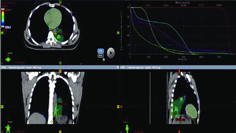 Radiotherapy Plan For Primary Lung Mass Showing Target Volume Coverage