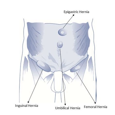 Types Of Chest Hernias At Franklin Norwood Blog