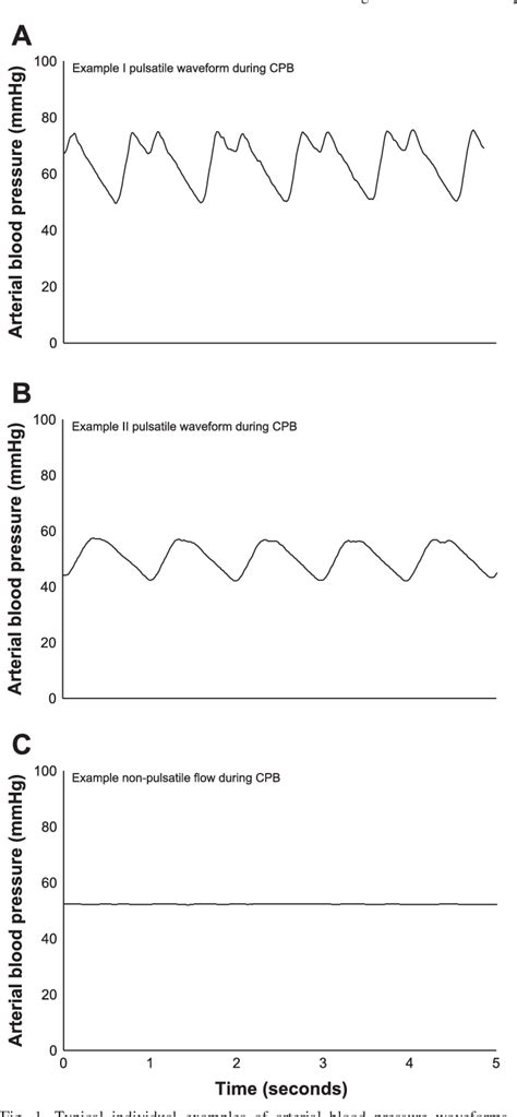 Figure 1 From Pulsatile Flow During Cardiopulmonary Bypass Preserves Postoperative