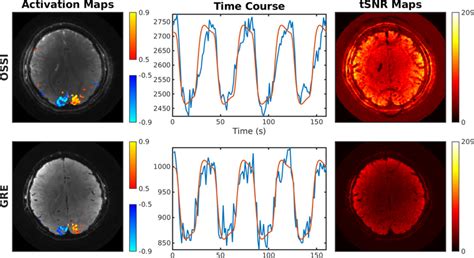 Oscillating Steady State Imaging Ossi A Novel Method For Functional