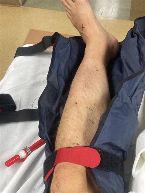 Broken Tibia 5 Times Fibula 1 R Brokenbones