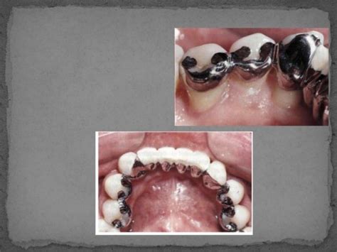 Preparation For Partial Coverage Crowns