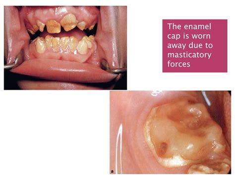 Developmental Disturbances Of Tooth Structure Pdf