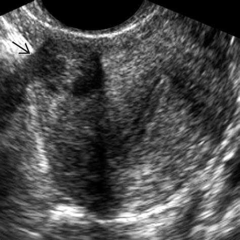 Endometrioma Radiology Key