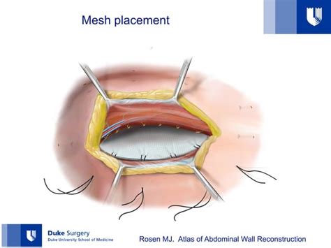 Abdominal Wall Anatomy With Respect To Understanding Component