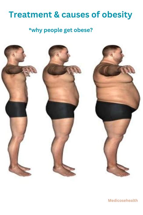 Obesity Causes Risk Factor Symptoms And Treatment Artofit