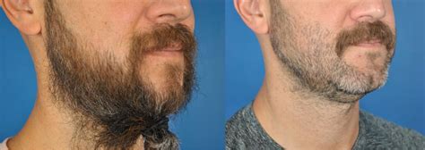 Patient 179748964 Mandibular Angle Augmentation Before And After Photos