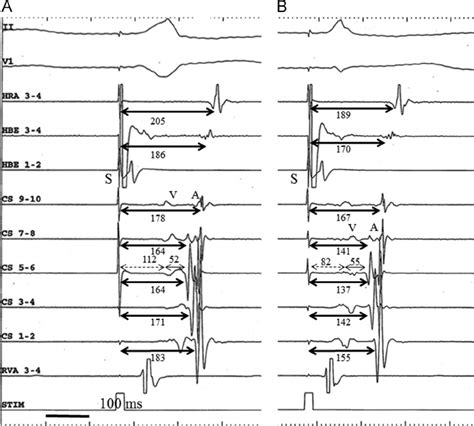 Pattern 2 Of Php Patient No 5 The Pacing Stimulus S In A Did Not