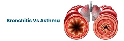 Bronchitis Vs Asthma Key Differences Symptoms And Treatment