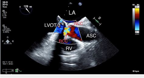 Figure 2 From Iatrogenic Acute Aortic Insufficiency Following Mitral