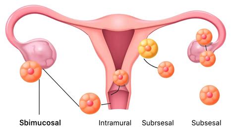Can Fibroids Hide Pregnancy Understanding Risks