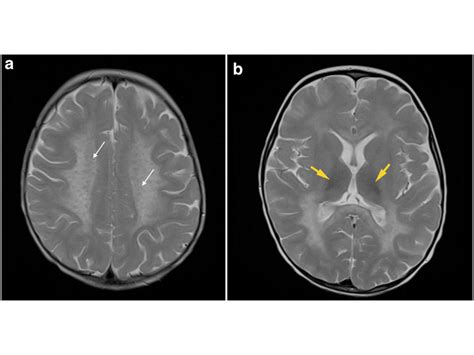 A In Addition To The Hyperintense Appearance Of White Matter Diffuse Download Scientific
