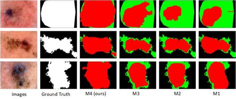 Enhancing Skin Lesion Segmentation With A Fusion Of Convolutional Neural Networks And